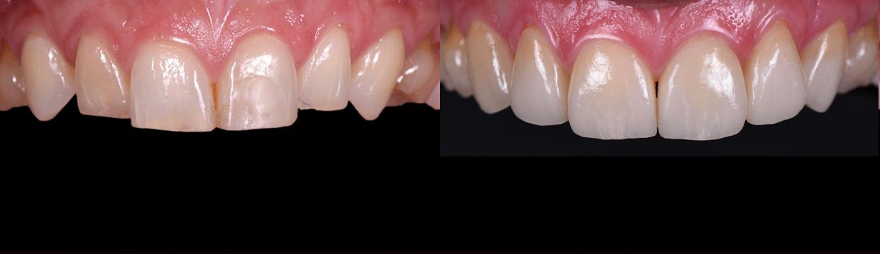 Expert Dental Veneers in London - Wimpole Street Dental Clinic