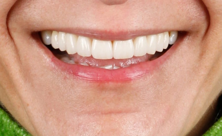 Smile Makeover London - Wimpole Street Dental Clinic