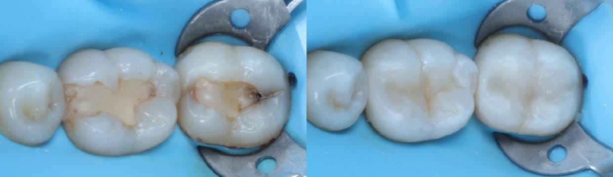 Dental Fillings London | Specialist Composite Restorations