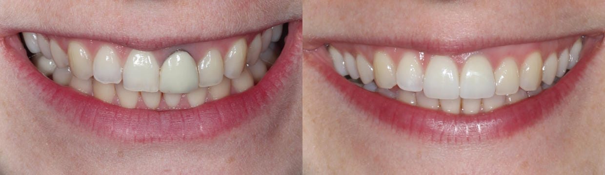 Internal Bleaching - Before Afters - Wimpole Street Dental Clinic