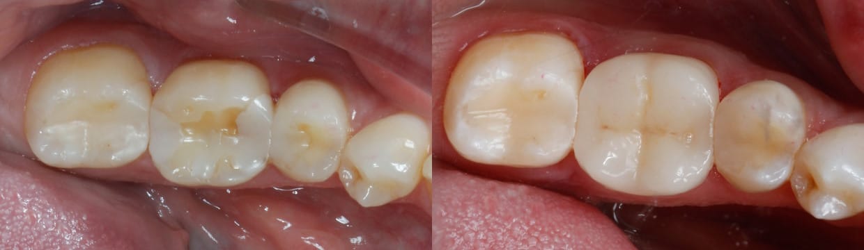Inlays and Partial Crowns at Wimpole Street Dental Clinic, London