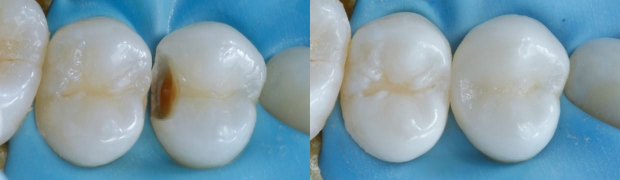 Fillings - Before Afters - Wimpole Street Dental Clinic